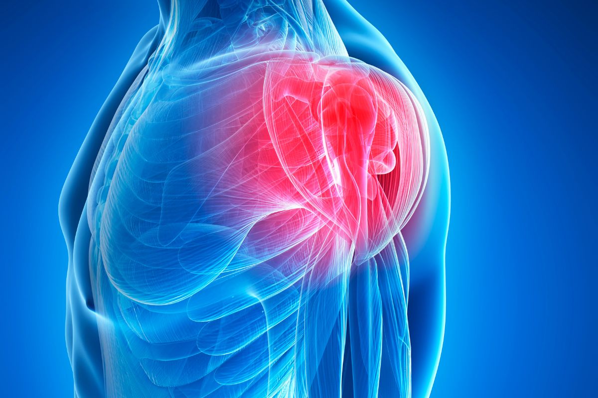 Lesão do Manguito Rotador - Curi Ortopedia | Especialista em ombro e ...