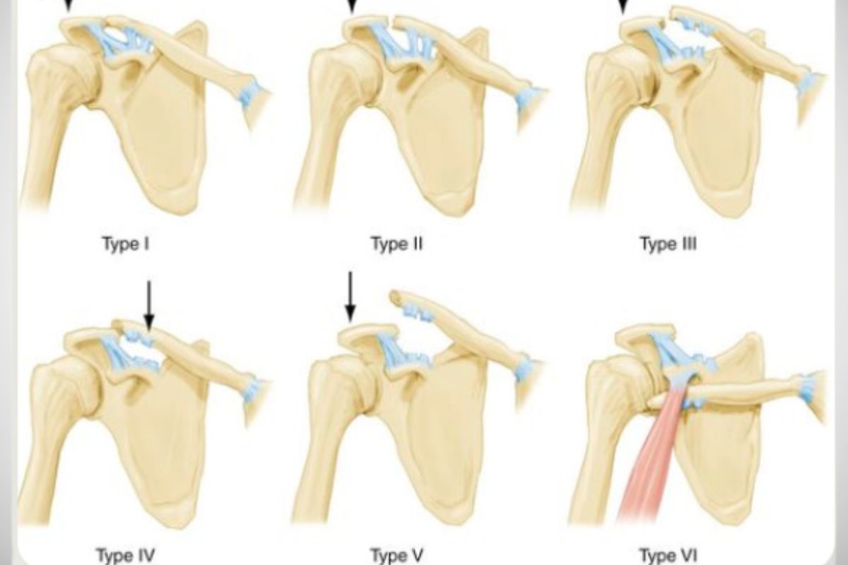 Luxação acromioclavicular - Curi Ortopedia | Especialista em ombro e ...